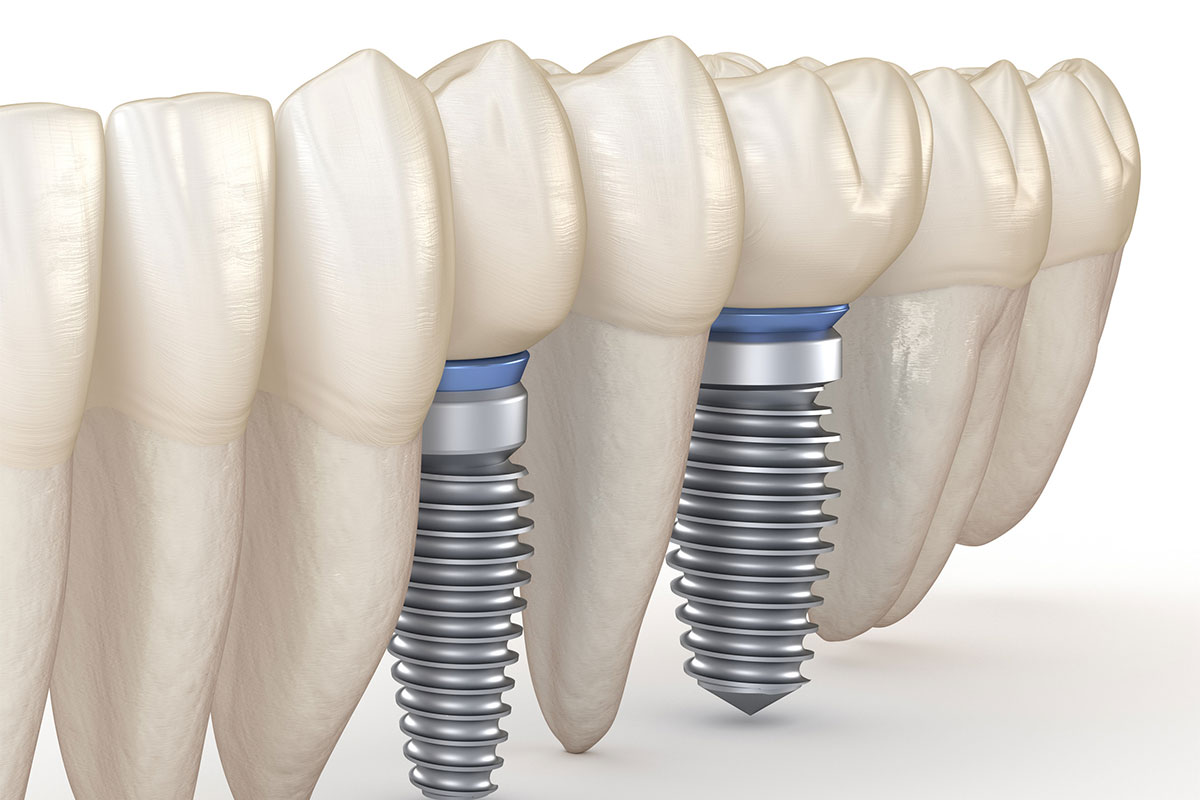 Fusion Dental Implant Club