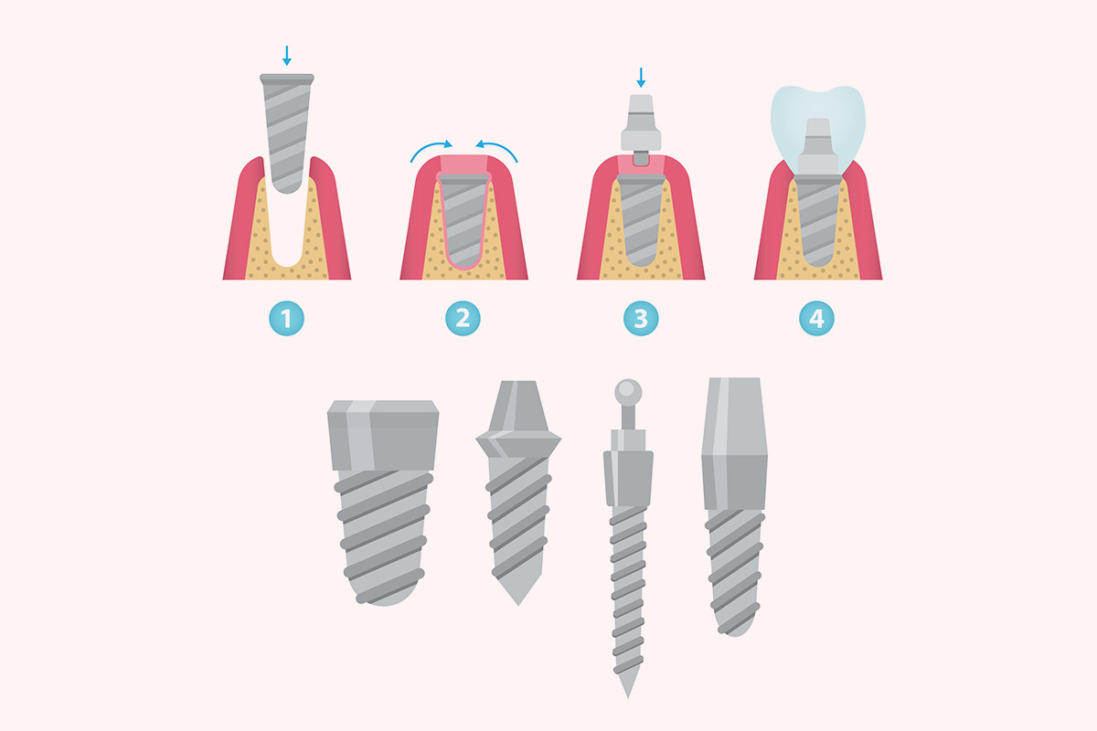 Fusion Dental Implant Club